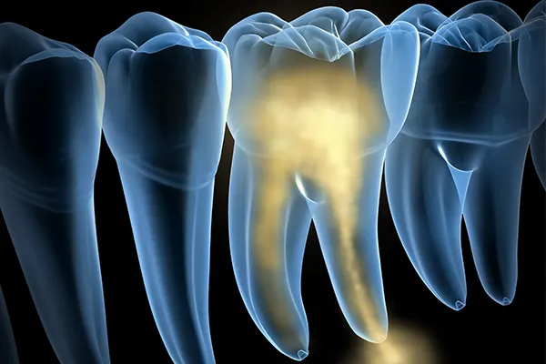 8 Αιτίες πονόδοντου και τι πρέπει να κάνετε | Aesthetic Dental Clinic