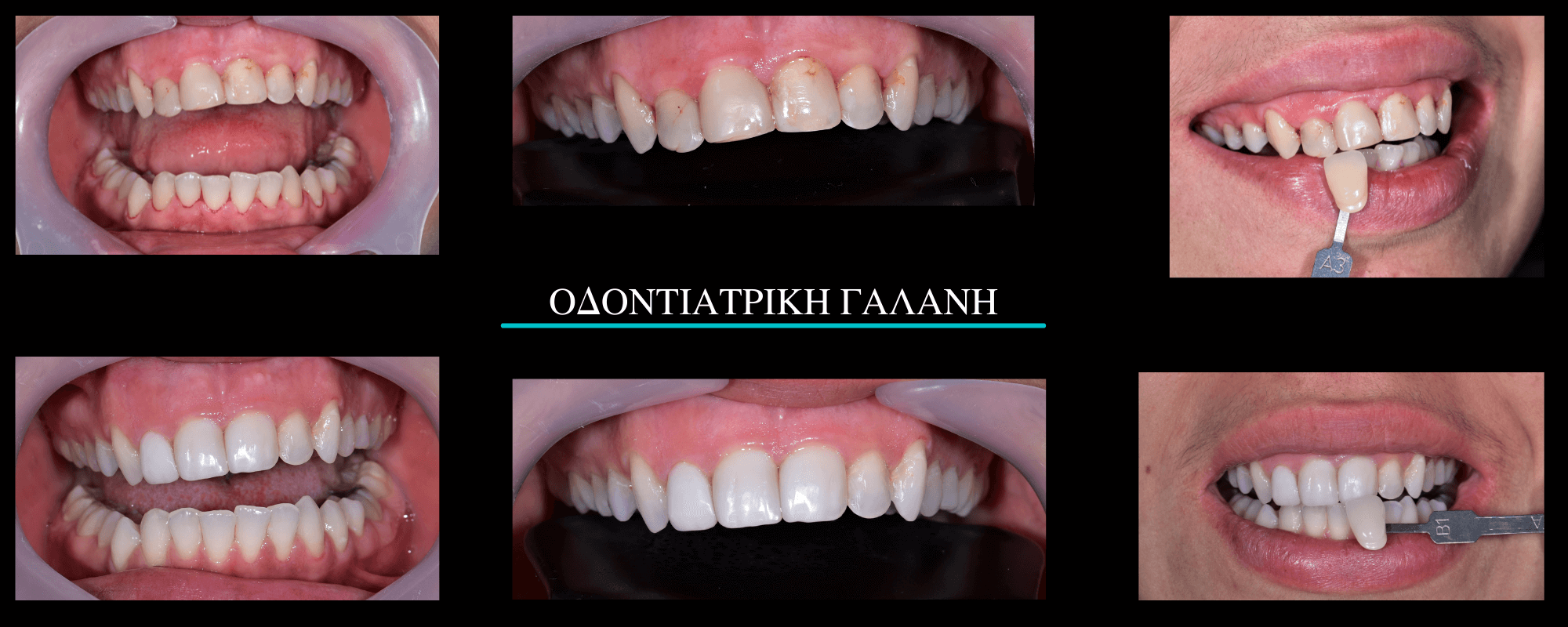Όψεις Ρητίνης | Aesthetic Dental Clinic