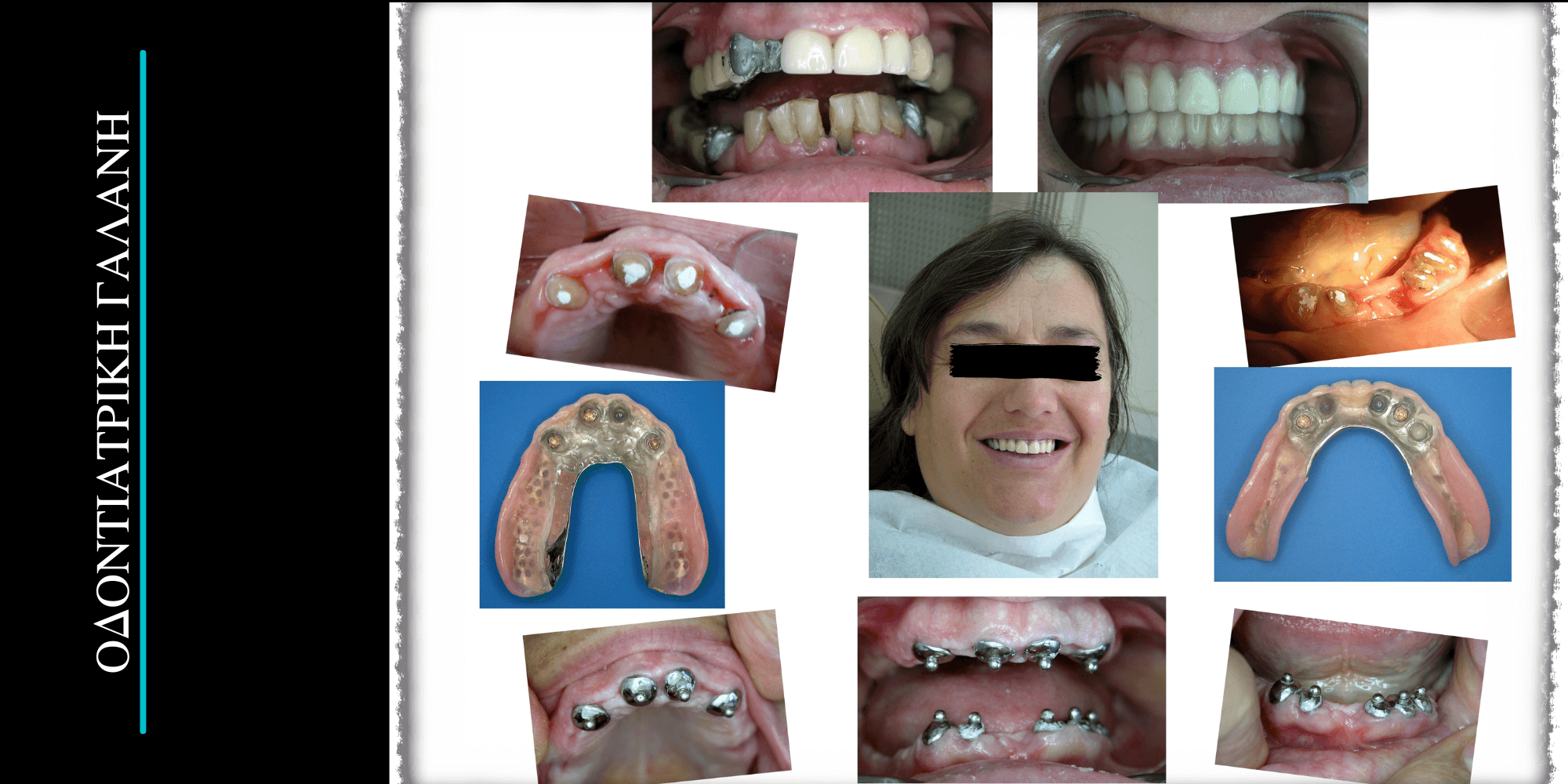 Οδοντοστοιχίες | Aesthetic Dental Clinic