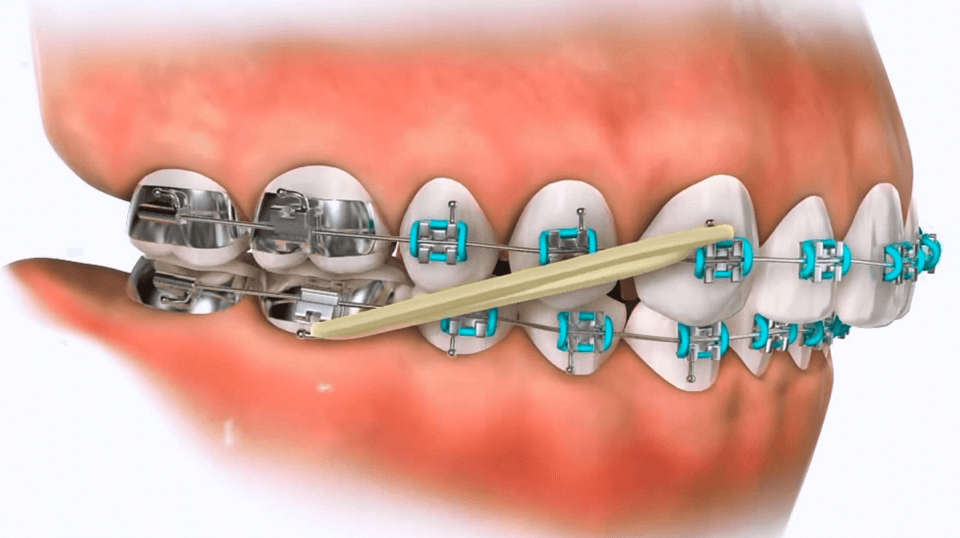 Οδηγίες για τα σιδεράκια | Aesthetic Dental Clinic