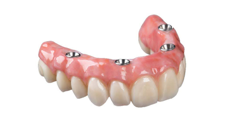 Οδοντοστοιχία (Μασέλα) χωρίς Ουρανίσκο | Aesthetic Dental Clinic